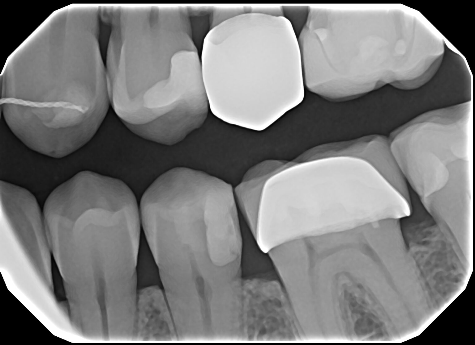 DentiMax PRO Sensor: Your Ultimate Imaging Solution