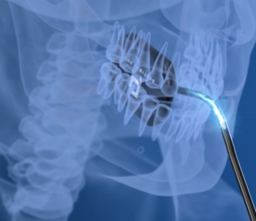 How to Get Low Radiation Dental X-Rayswith the Pro Sensor - DentiMax